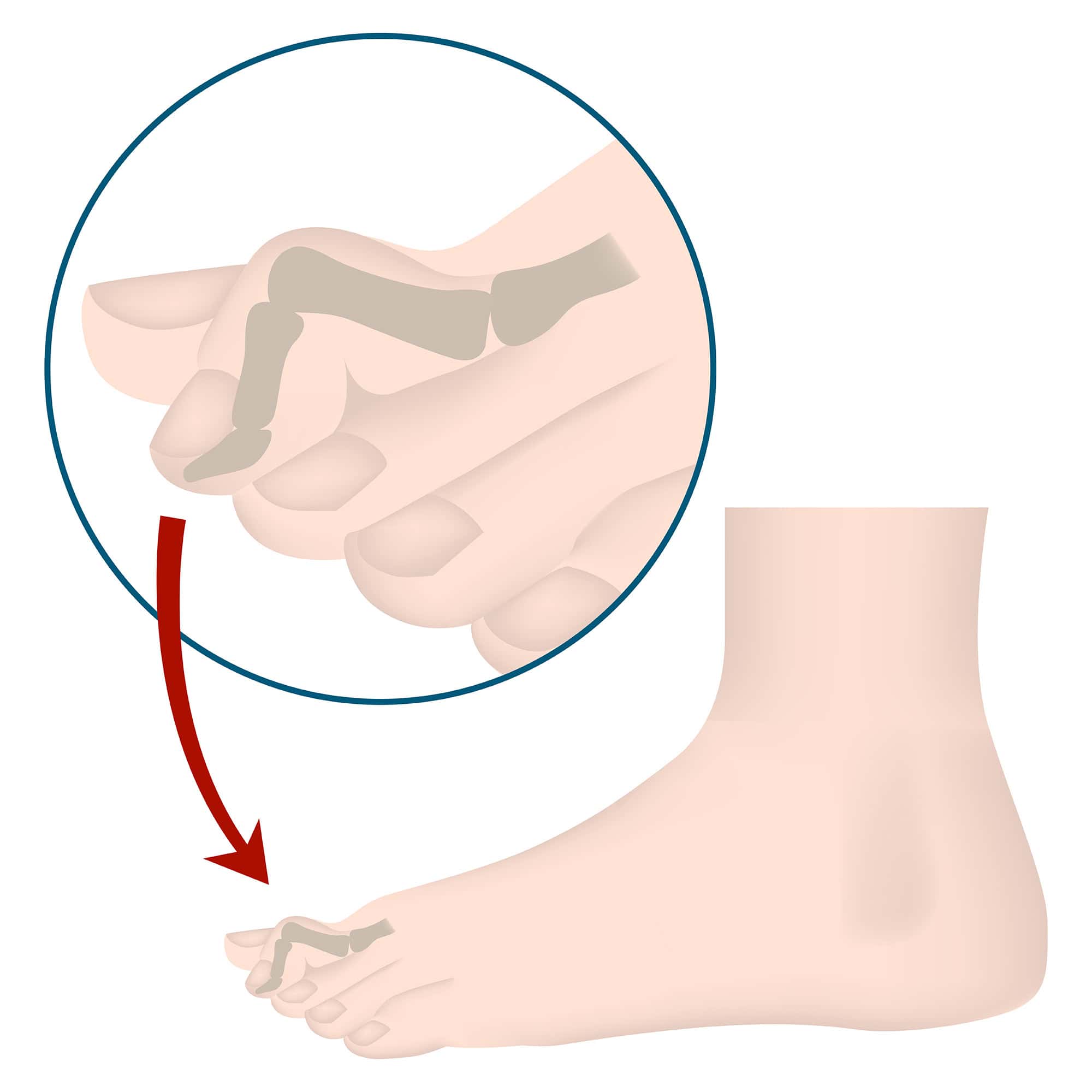 Discover the Benefits of Minimally Invasive Hammertoe Correction at ...